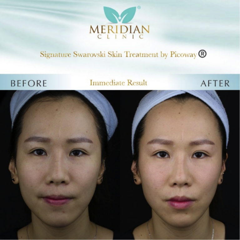 Signature Swarovski Radiant Skin Treatment with PicoWay Laser ...